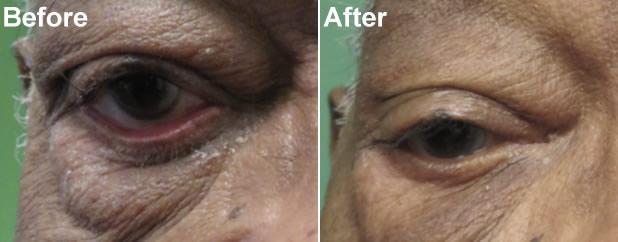 Entropion Treatment in Phoenix, Arizona | Oculoplastic Eye Surgeons