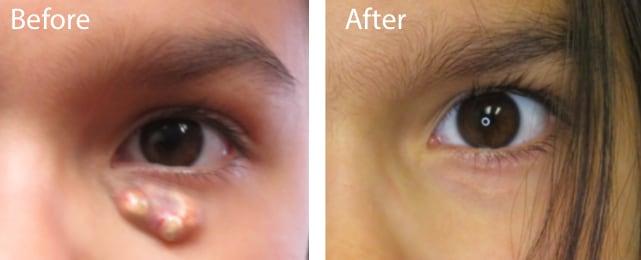 Eye Lesion Treatment in Phoenix, Arizona | Oculoplastic Eye Surgeons