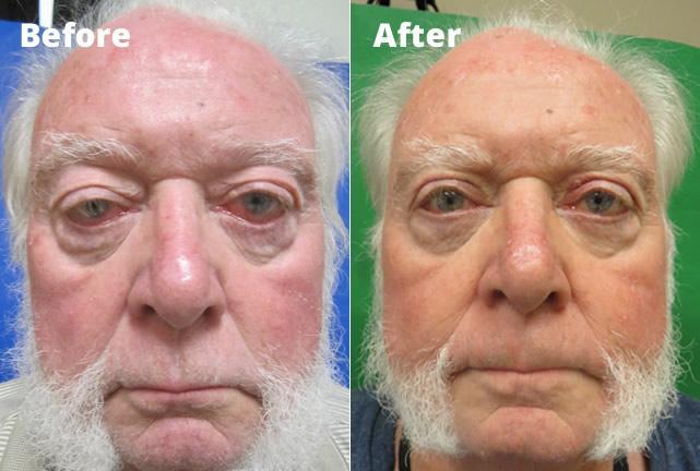 Eye Retraction in Phoenix, AZ | Oculoplastic Eye Surgeons