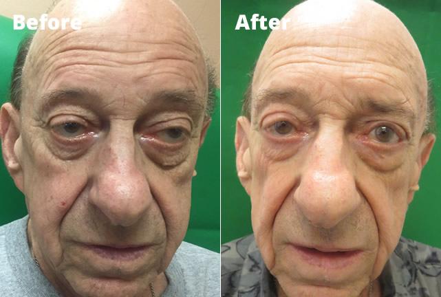 Lower Eyelid Recession Specialist in Phoenix, Arizona