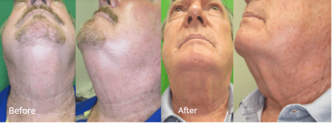 Kybella Before & After Images | Oculoplastic Eye Surgeons of Phoenix
