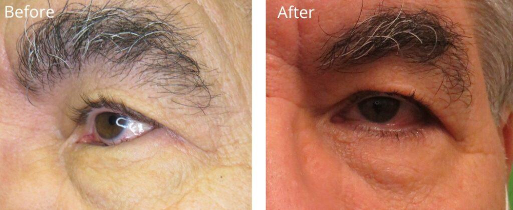 Entropion Treatment in Phoenix, Arizona | Oculoplastic Eye Surgeons